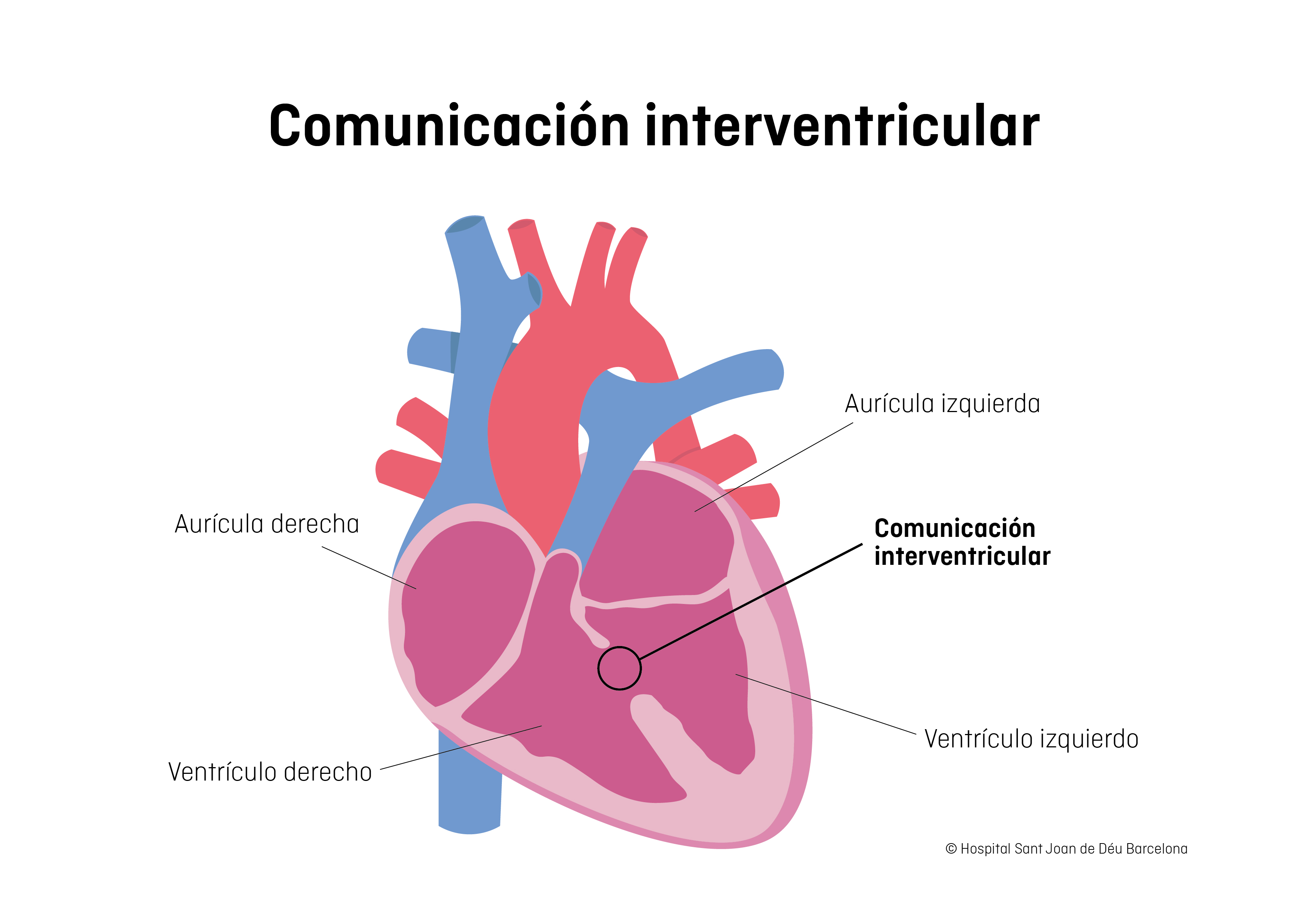 Comunicación Interventricular Escola De Salut Sjd